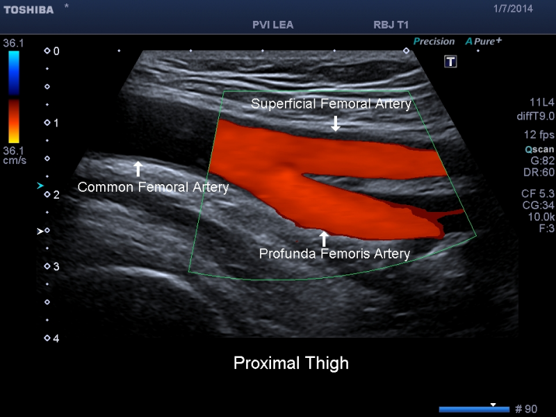 Chronic Venous Insufficiency - Pedes Orange County