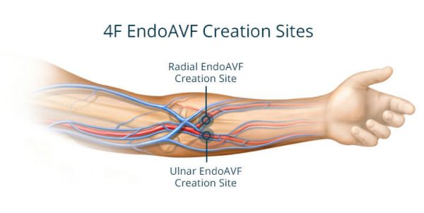 Endovascular Surgery | EndoAVF | Pedes Orange County