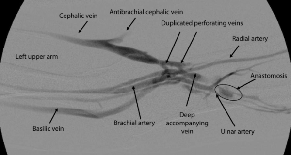 Endovascular Surgery | EndoAVF | Pedes Orange County