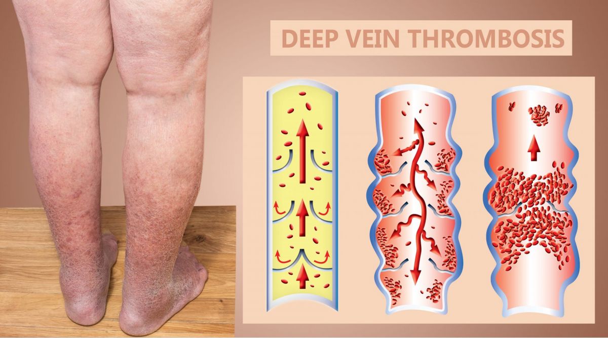 Chronic Venous Insufficiency - Signs, Symptoms, & Complications - Pedes ...